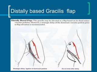 Uper n middle third leg defects | PPTX