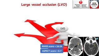 Aspiration vs Mechanical Thrombectomy | PPTX