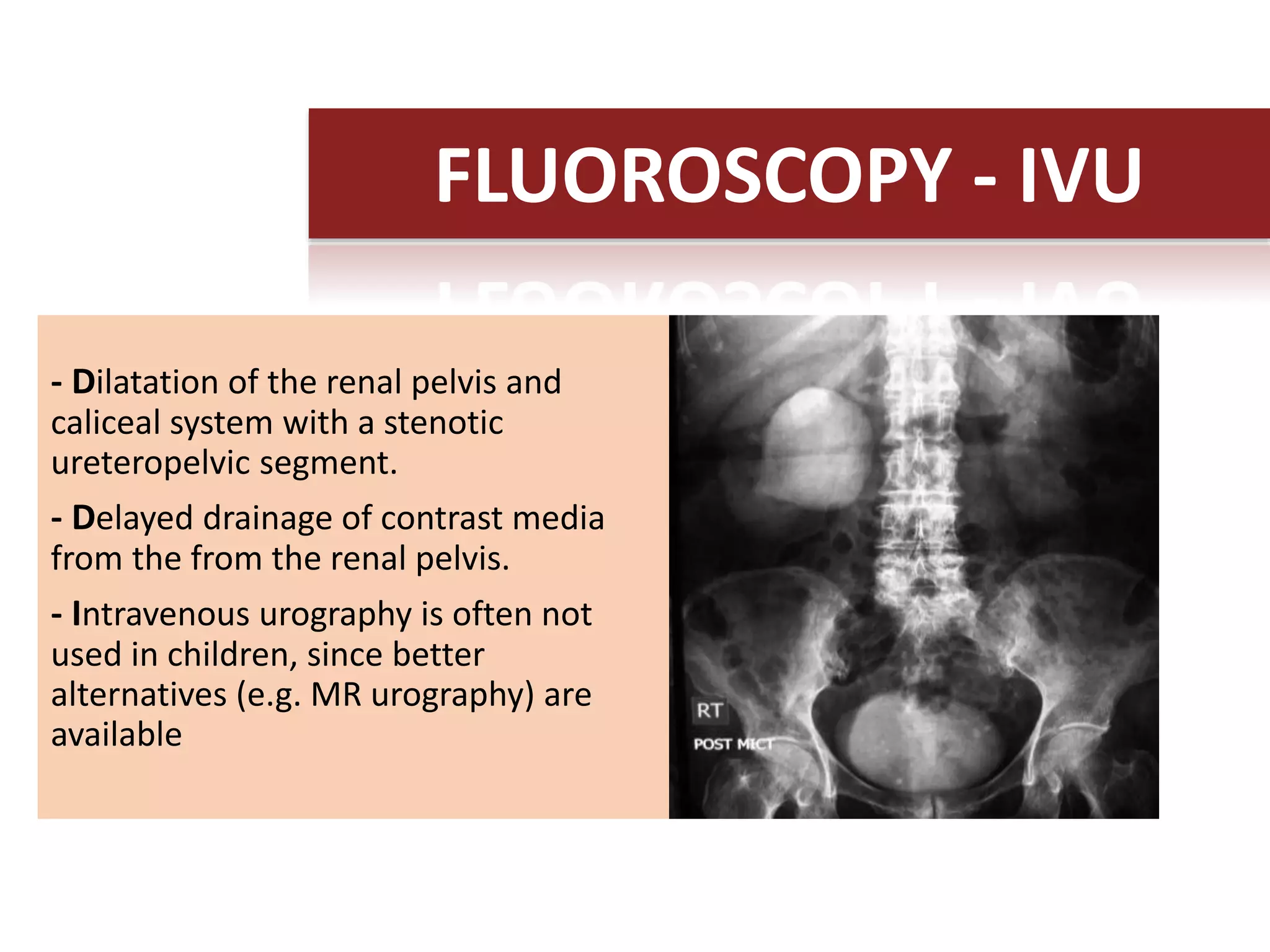 Upj obstruction | PPTX