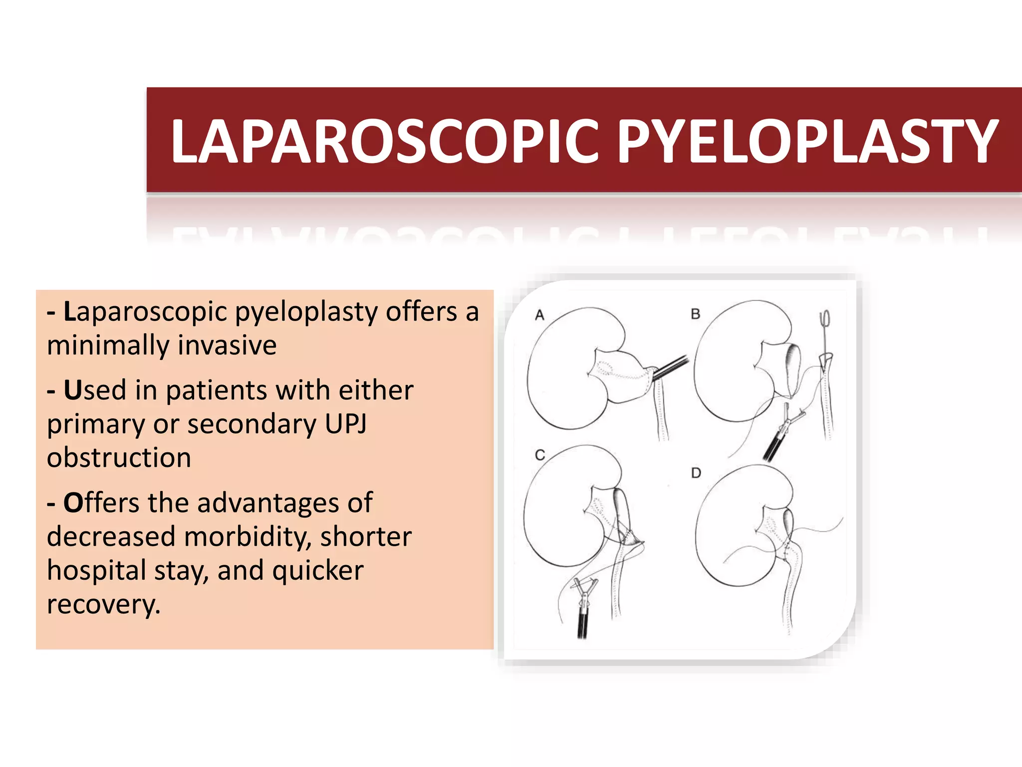 Upj obstruction | PPTX