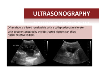 Upj obstruction | PPTX