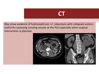 Upj obstruction | PPT