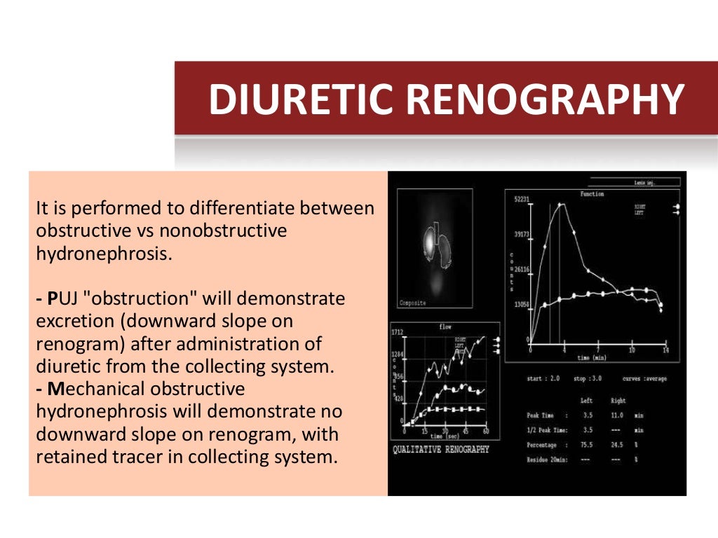Upj Obstruction Causes Symptoms Treatment Upj Obstruction