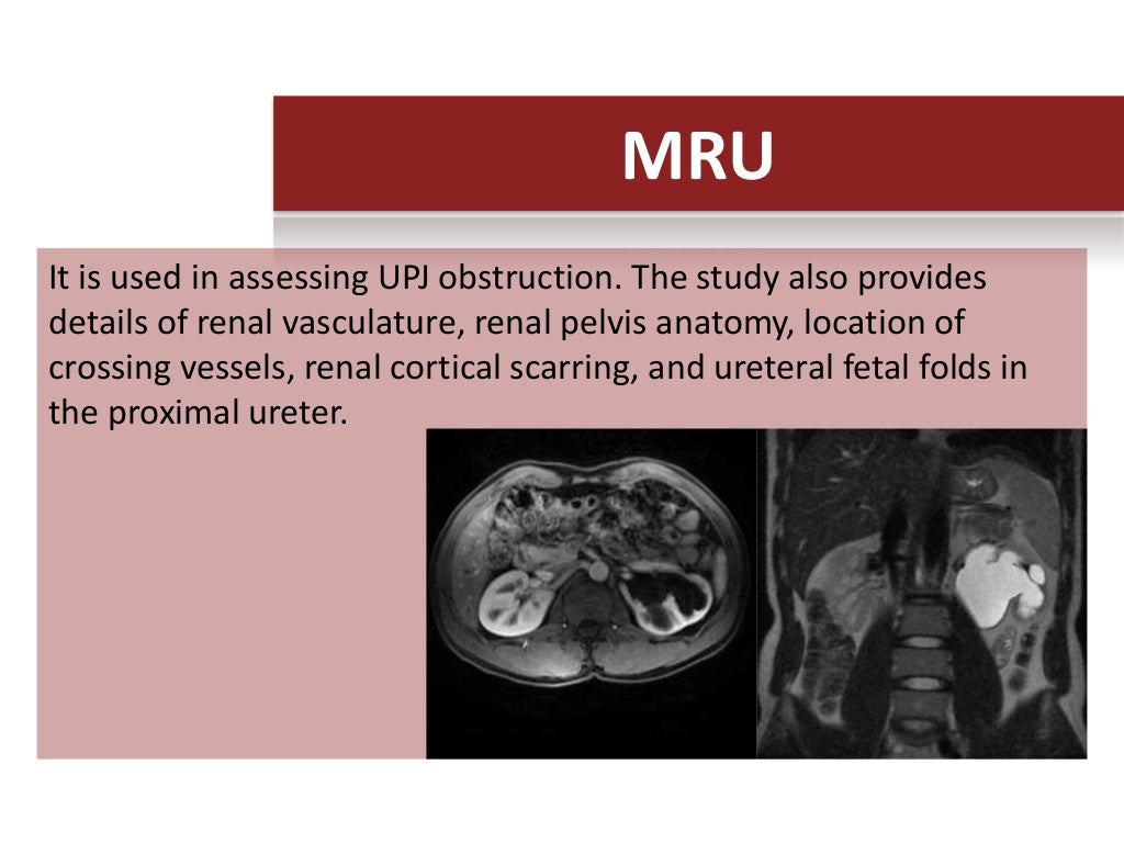 Upj Obstruction Causes Symptoms Treatment Upj Obstruction