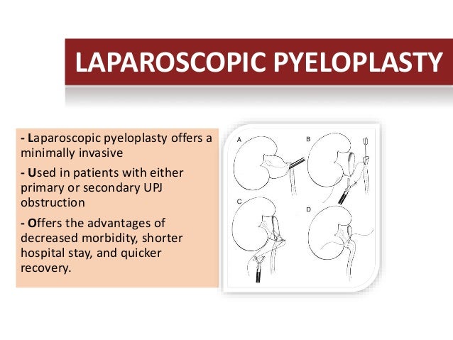 Upj Obstruction Causes Symptoms Treatment Upj Obstruction