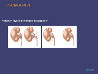 Ureteropelvic Junction (UPJ) Obstruction | PDF