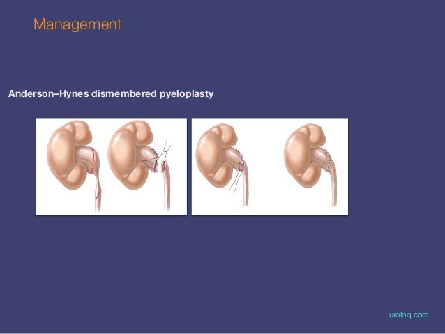 Ureteropelvic Junction (UPJ) Obstruction