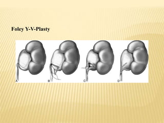 UPJ Obstruction | PPT