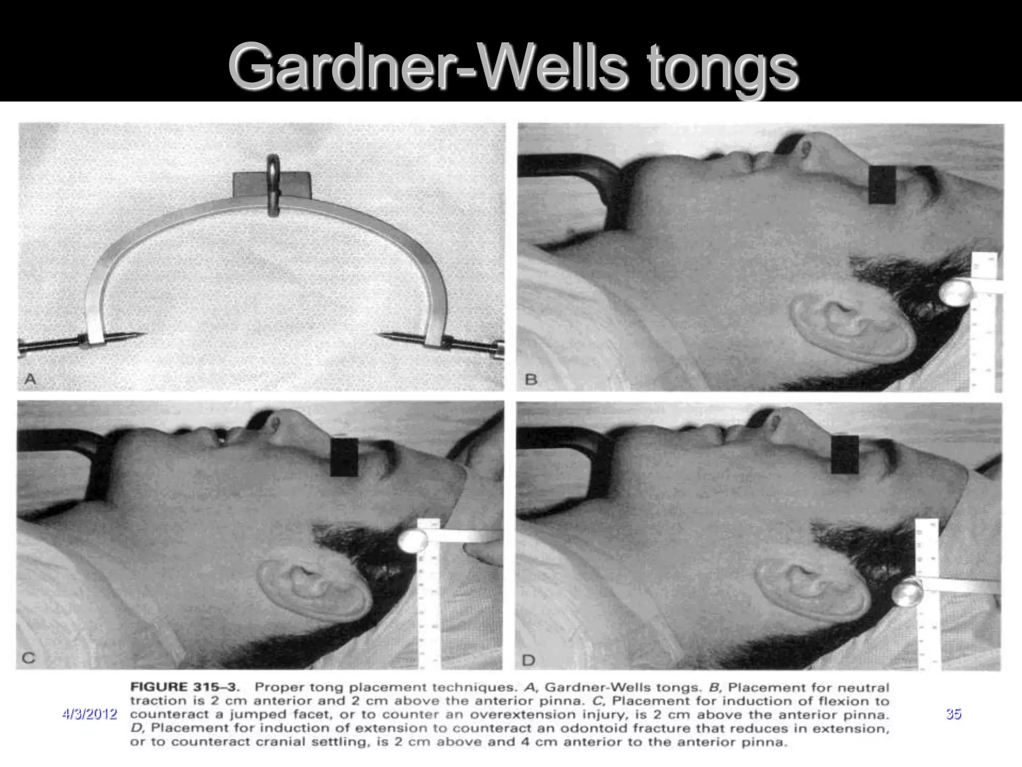 management of spinal cord injury | PPTX