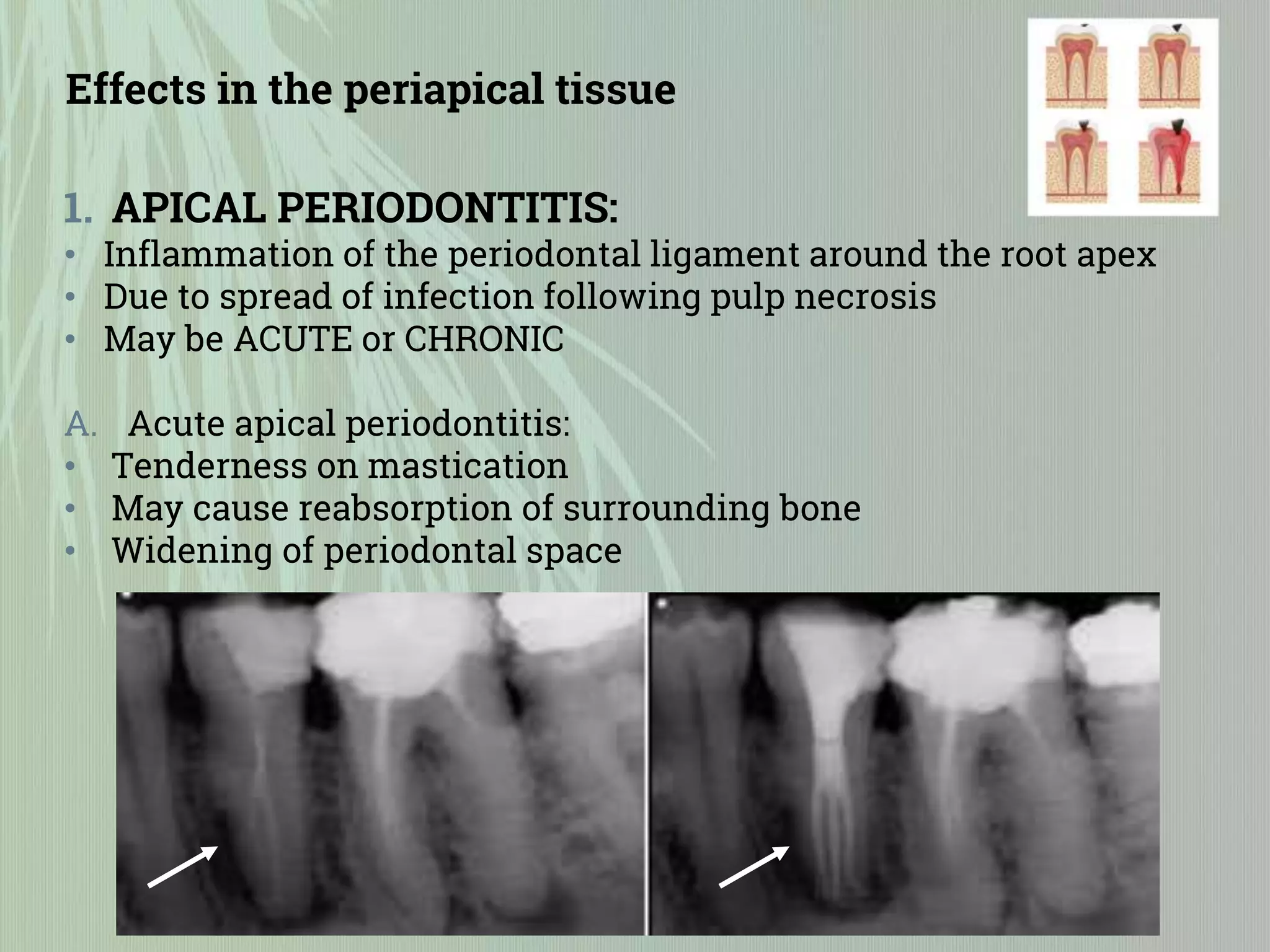 Sequelae of dental caries | PPTX