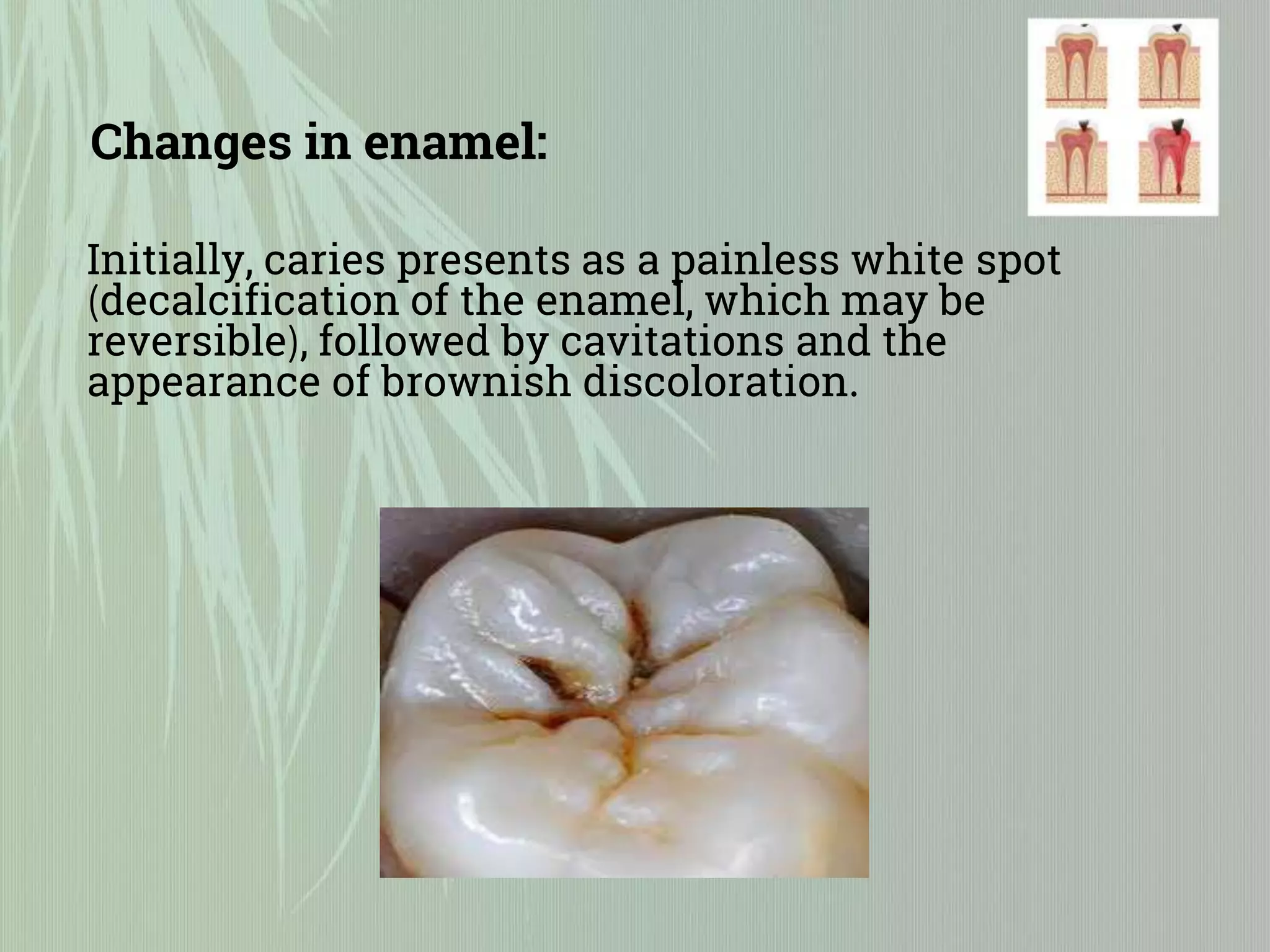 Sequelae of dental caries | PPTX