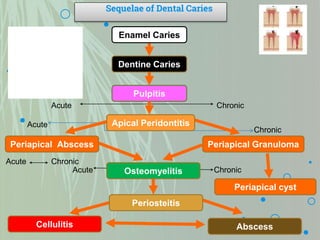Sequelae of dental caries