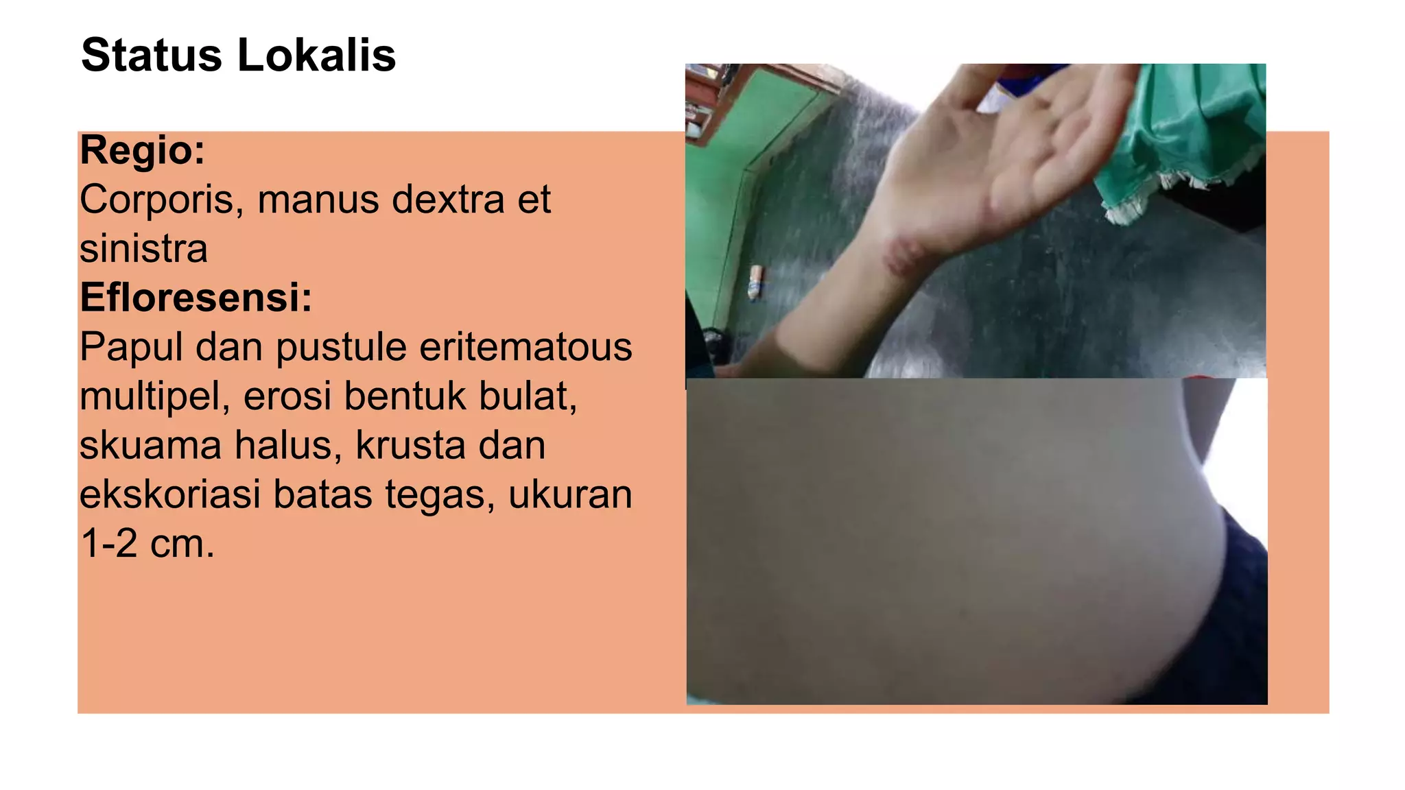 scabies.pptx
