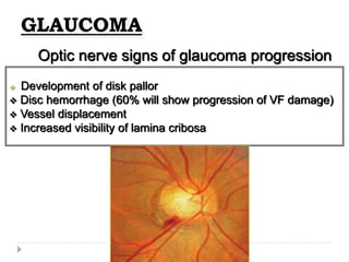 Glaucoma | PPTX