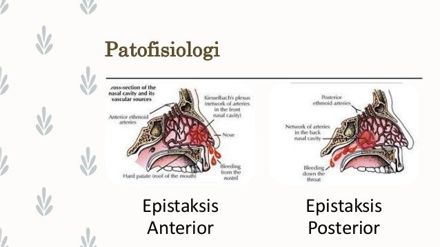 Epistaksis (ENT)