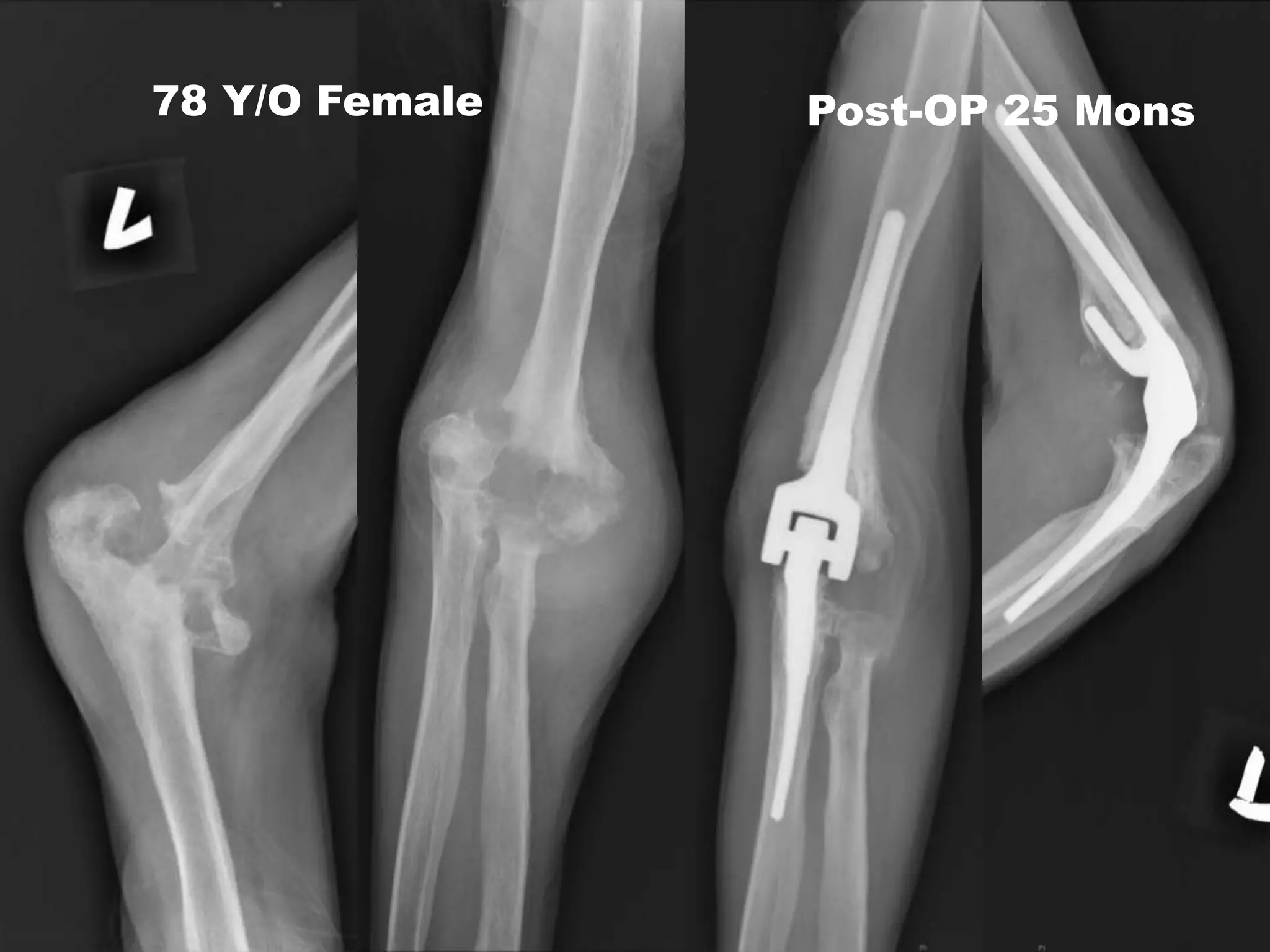 Total Elbow Arthroplasty As The Salvage procedure of Nonunion or ...