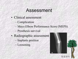 Total Elbow Arthroplasty As The Salvage procedure of Nonunion or ...