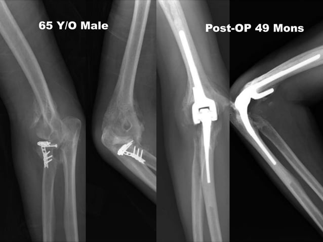Total Elbow Arthroplasty As The Salvage procedure of Nonunion or ...