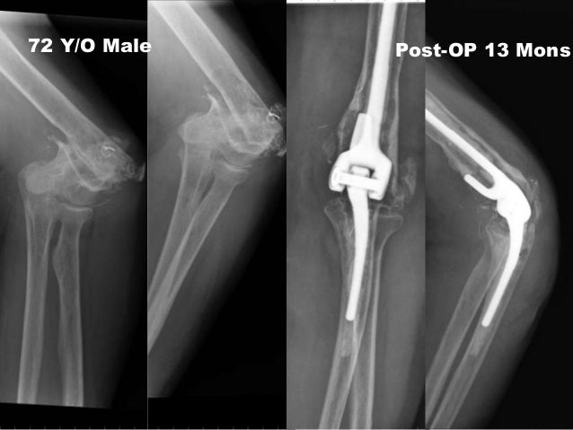 Total Elbow Arthroplasty As The Salvage procedure of Nonunion or Malu…