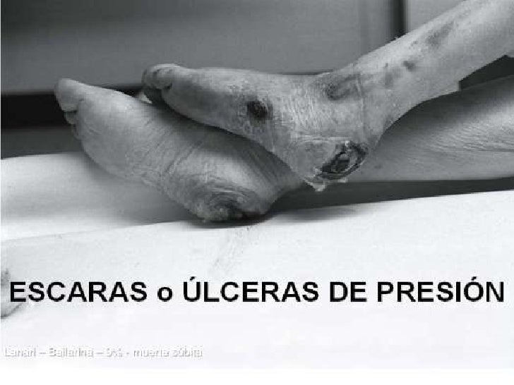 Ulceras por presión