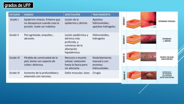 úlceras por presión