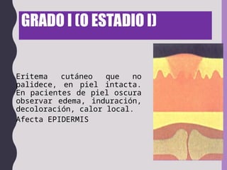 ULCERAS POR PRESION ENFERMERIA Y COMO TRATARLAS | PPT