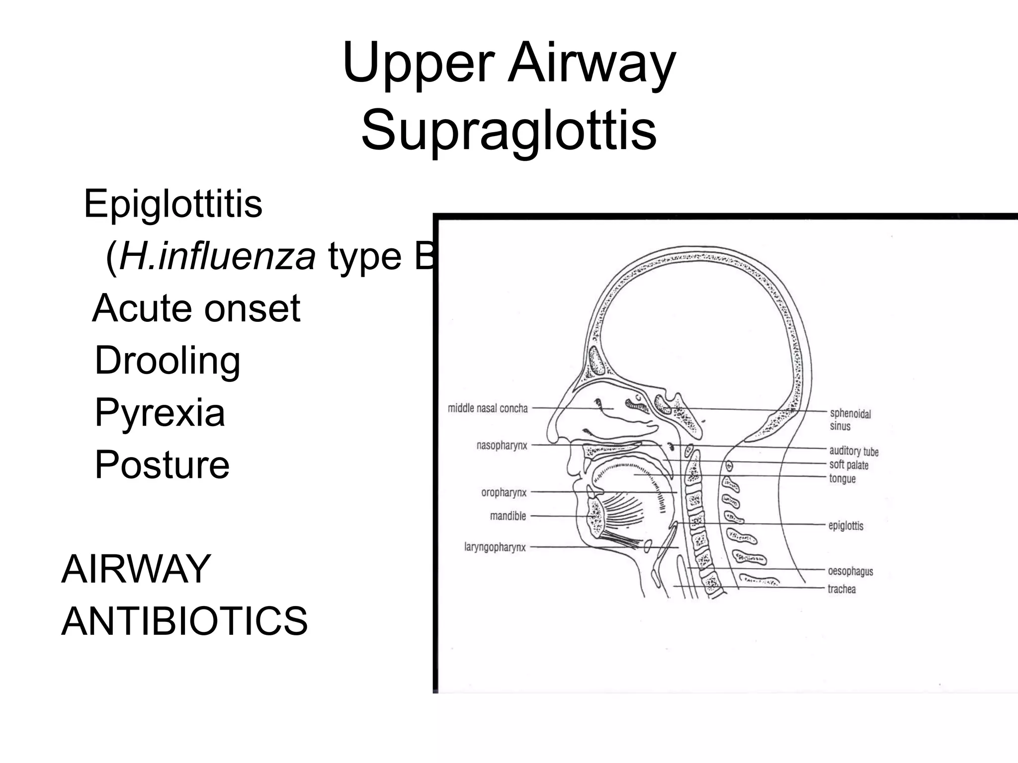 Upper airway-obstruction | PPT