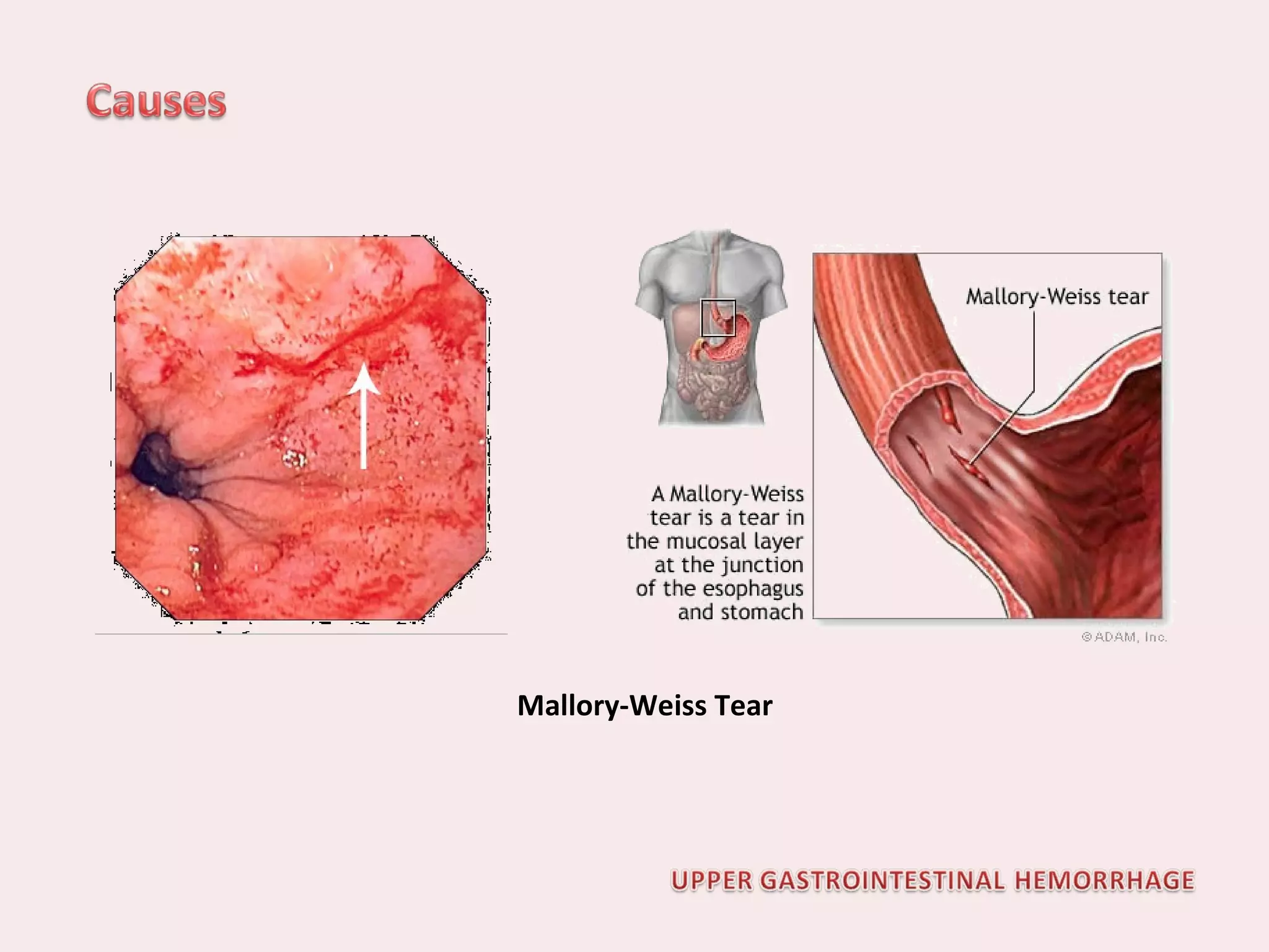 Upper Gastro-Intestinal Bleeding | PPT