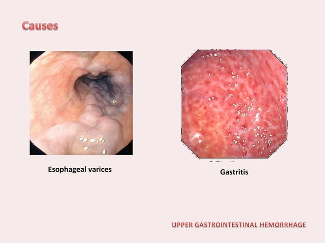 Upper Gastro-Intestinal Bleeding | PPT | Digestive Disorders | Diseases ...