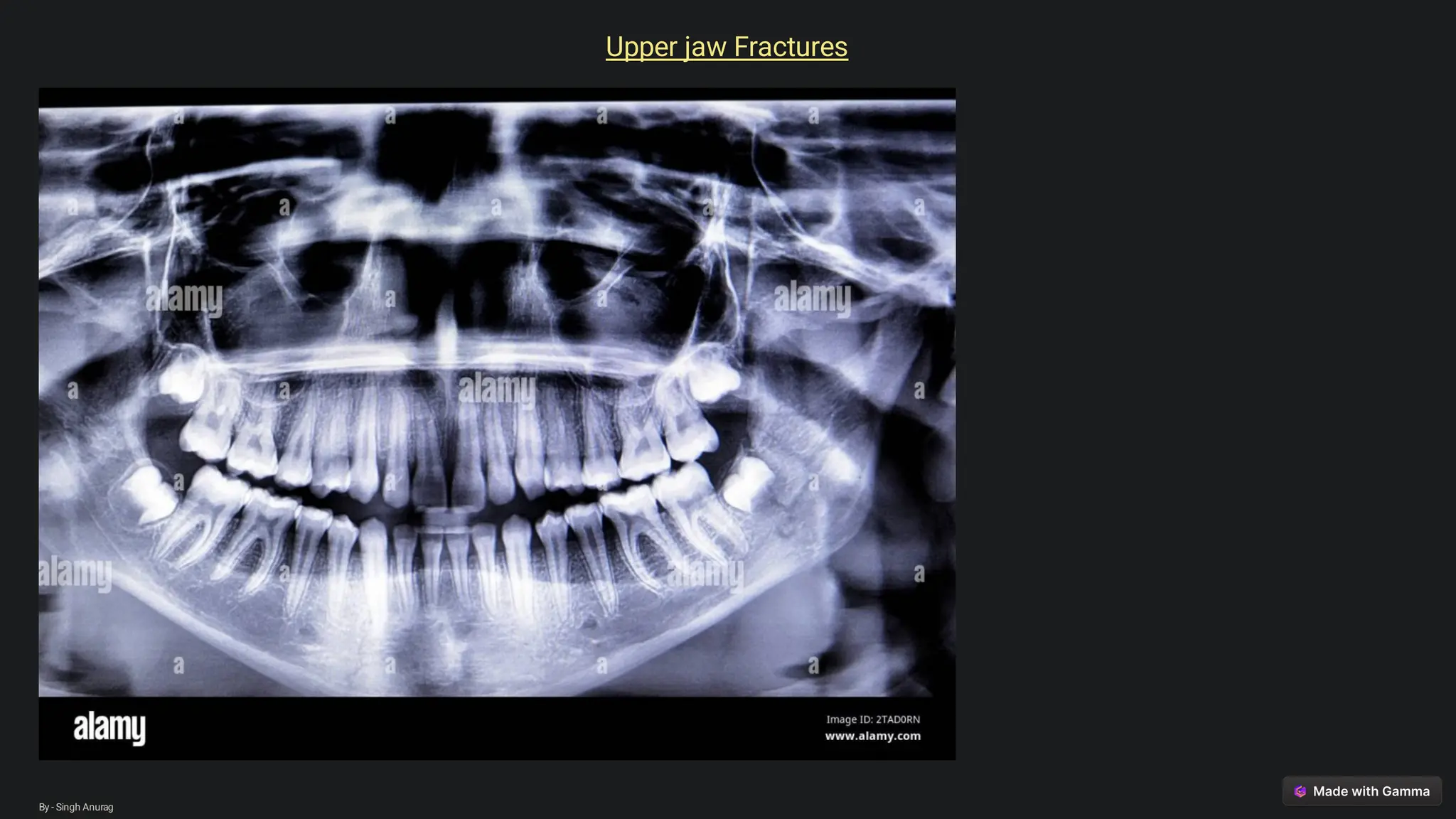 Upper-jaw-Fractures , mandible fracture . | PPT