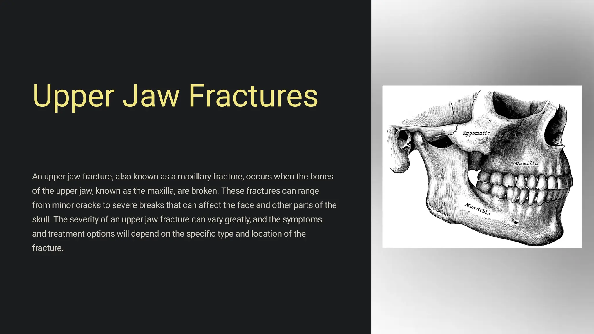 Upper-jaw-Fractures , mandible fracture . | PPT