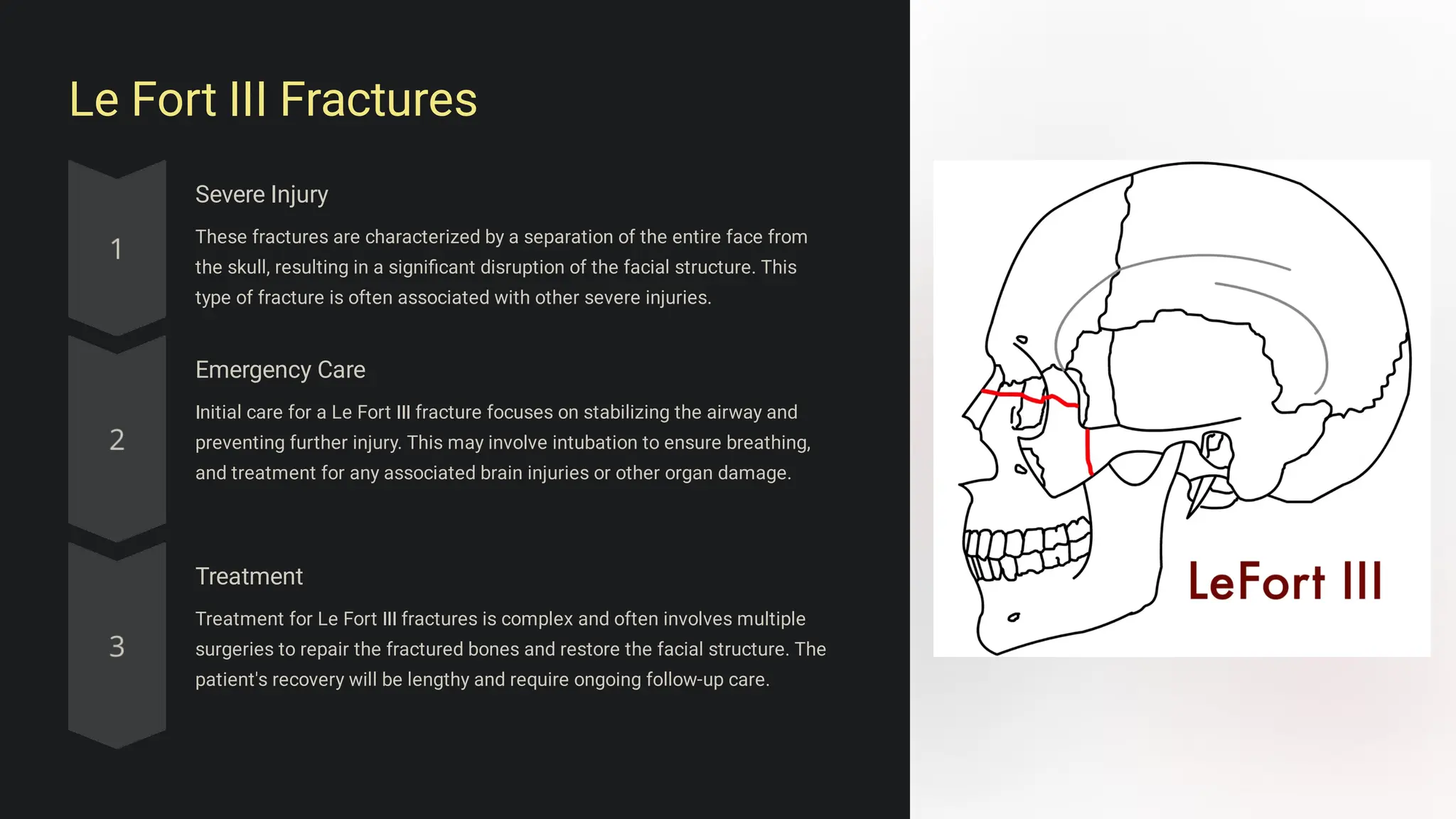 Upper-jaw-Fractures , mandible fracture . | PPT
