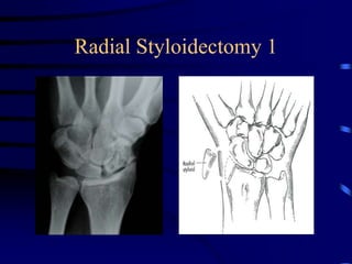 Upper limb-arthroscopy | PPSX