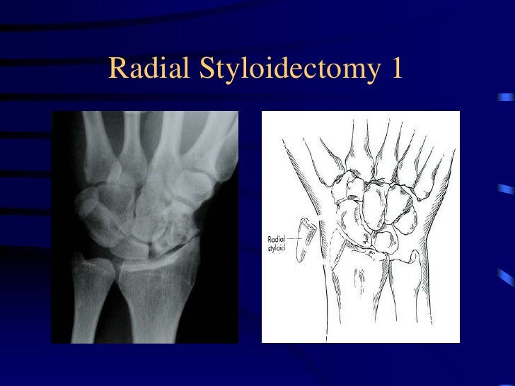 Upper limb-arthroscopy