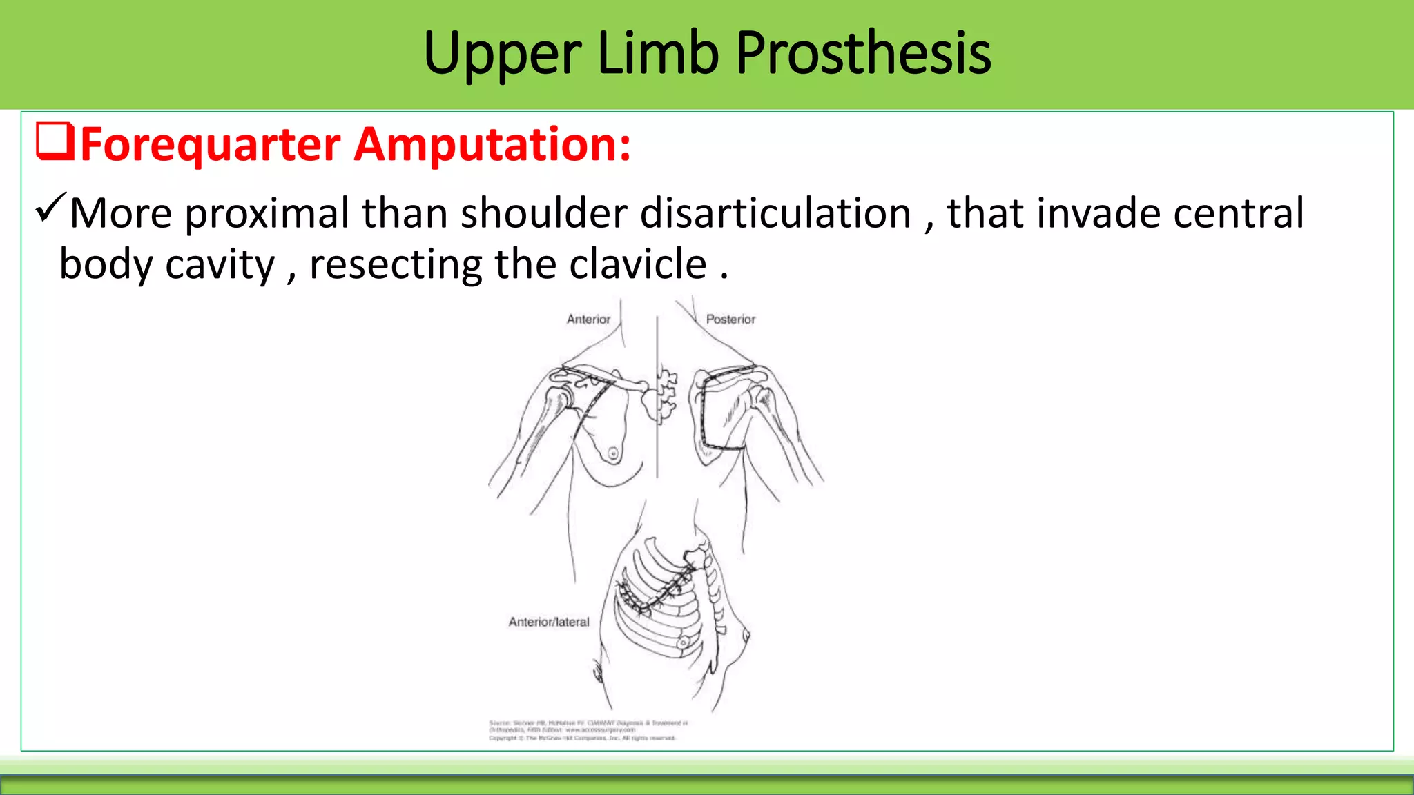 Upper limb-prosthesis-group1-presentation | PPTX