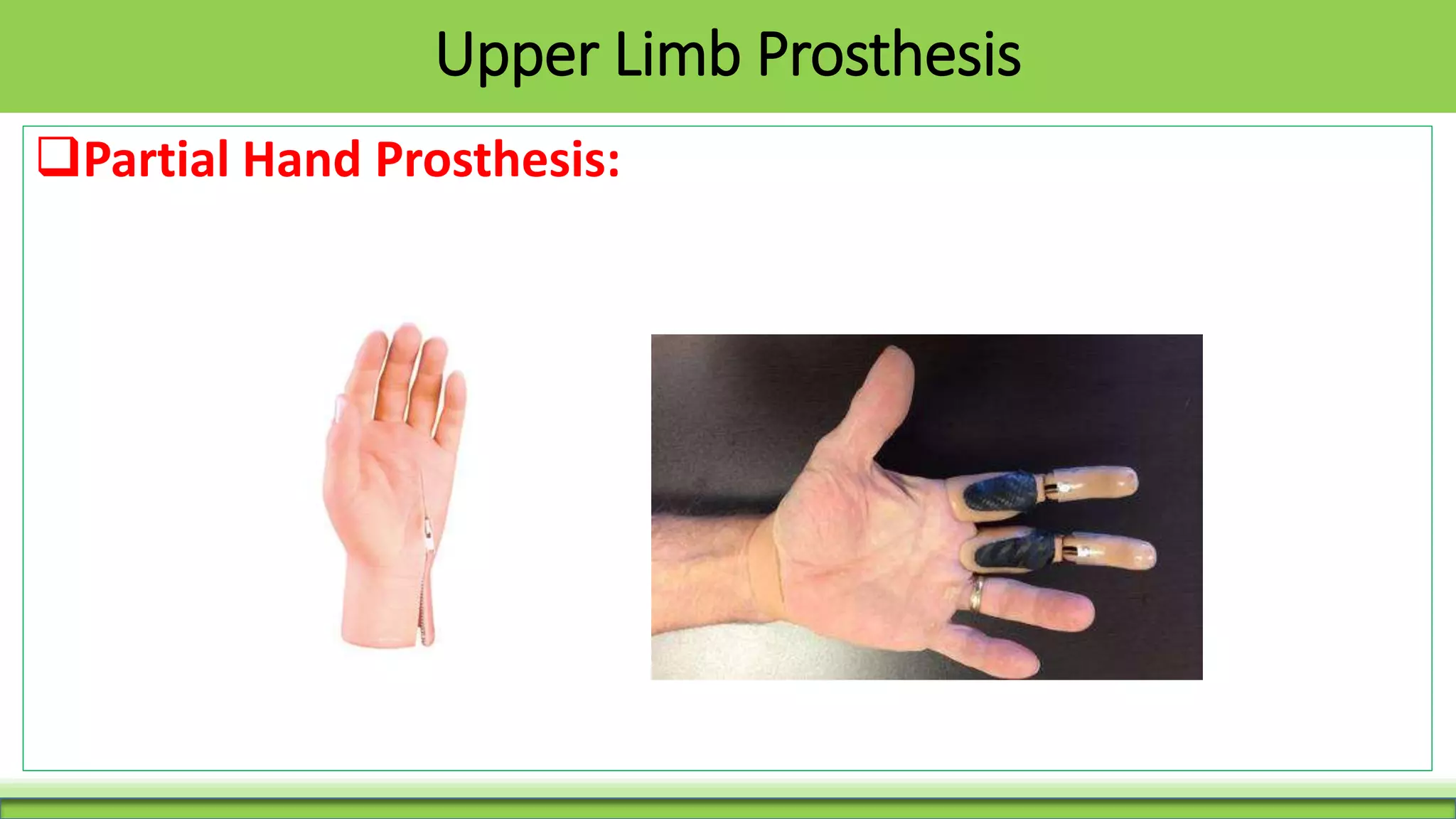 Upper limb-prosthesis-group1-presentation | PPTX