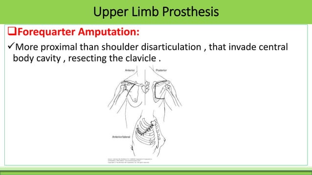 Upper limb-prosthesis-group1-presentation | PPTX