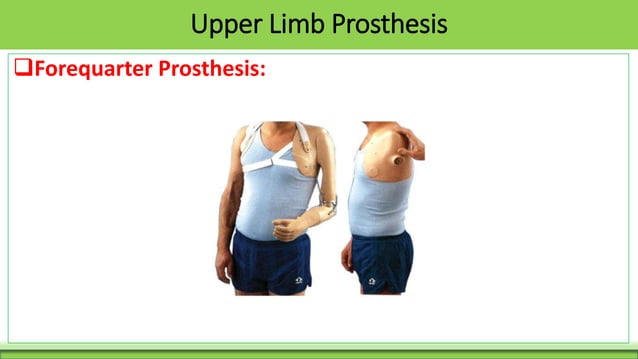 Upper limb-prosthesis-group1-presentation | PPTX