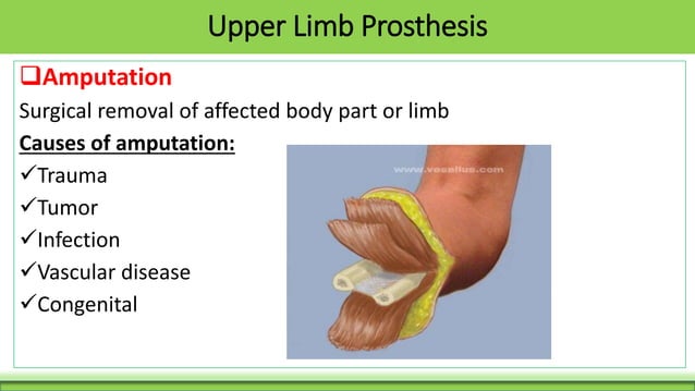 Upper limb-prosthesis-group1-presentation | PPTX