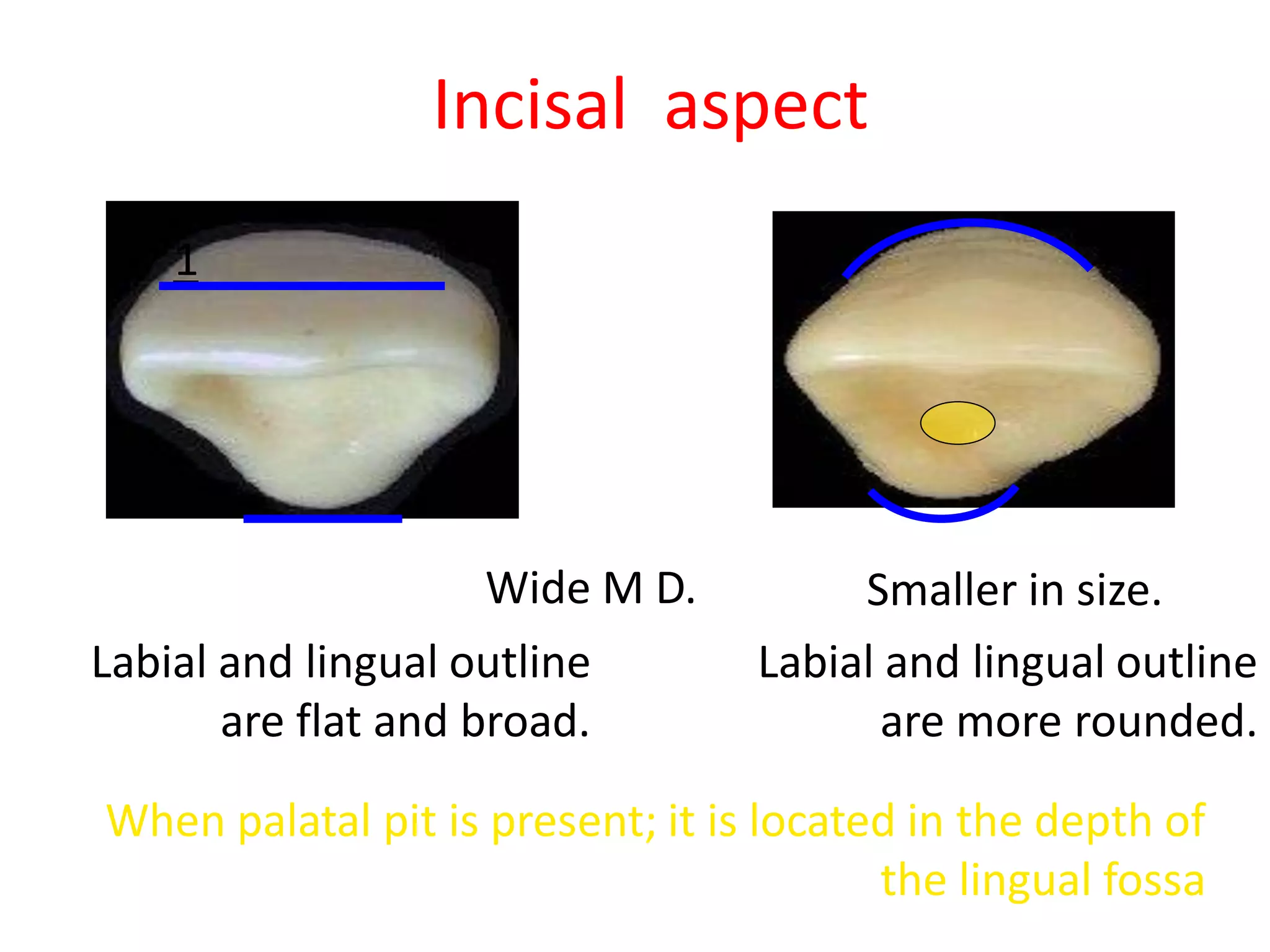 Upper Lateral Incisor | PDF