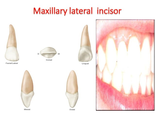 Upper Lateral Incisor | PPT