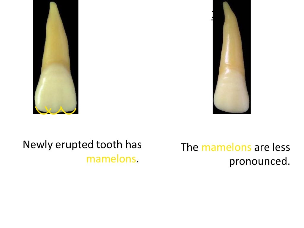 Upper Lateral Incisor