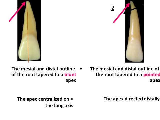 Upper Lateral Incisor