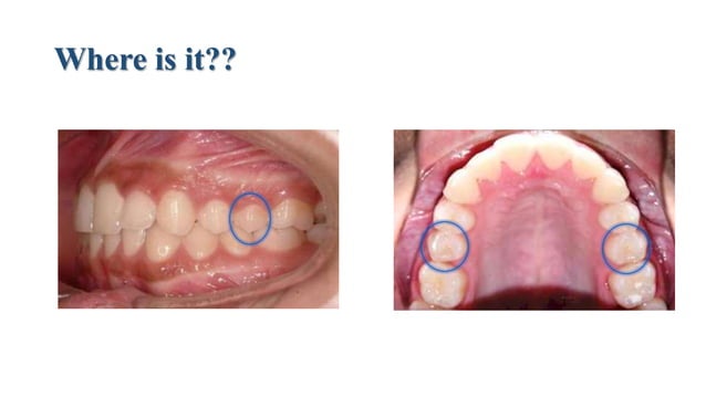 Maxillary second premolar | PPTX | Dental Health | Diseases and Conditions