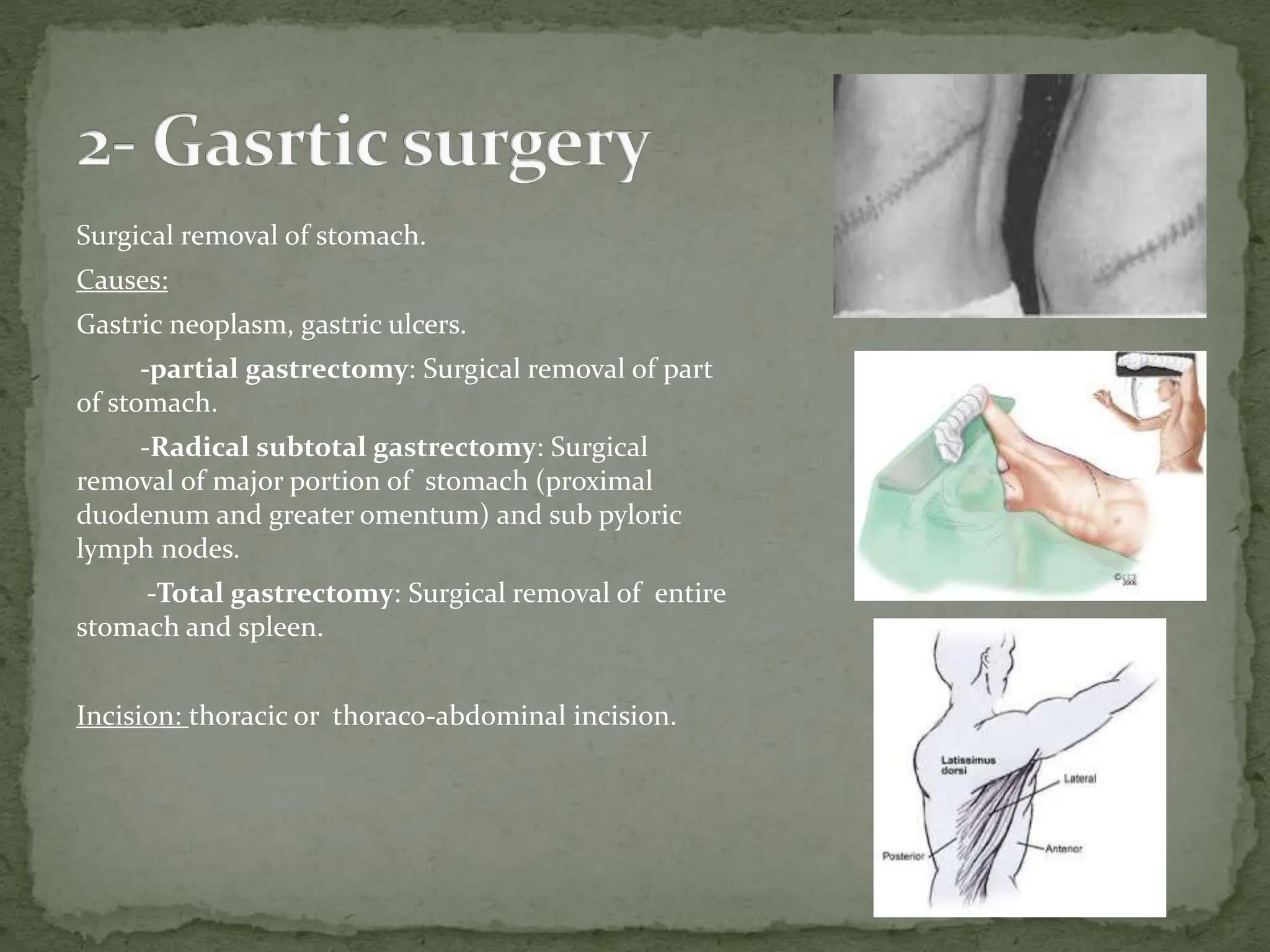 Upper abdominal surgery (hospital) pptx.pptx