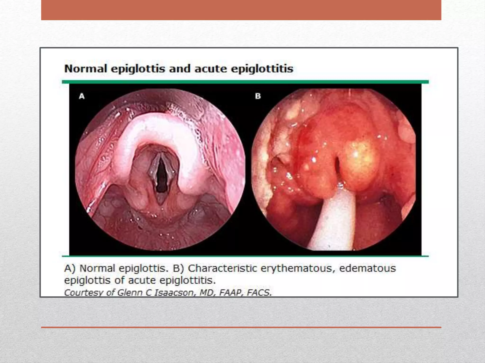 Upper airway obstruction | PPTX