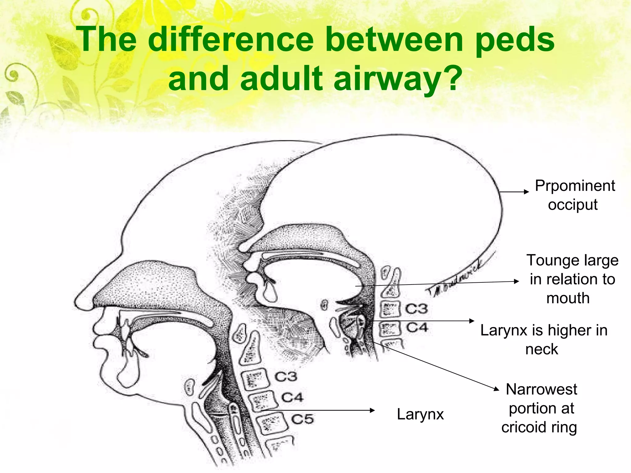 Upper Airway Obstruction Dr Juhina Clinical Serise | PPT