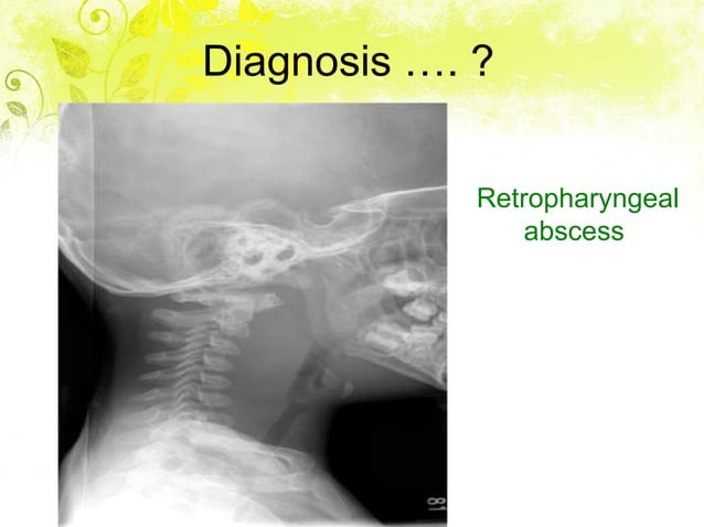 Upper Airway Obstruction Dr Juhina Clinical Serise | PPT | Ear, Nose ...