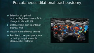 Ultrasound and the Upper Airway | PPTX
