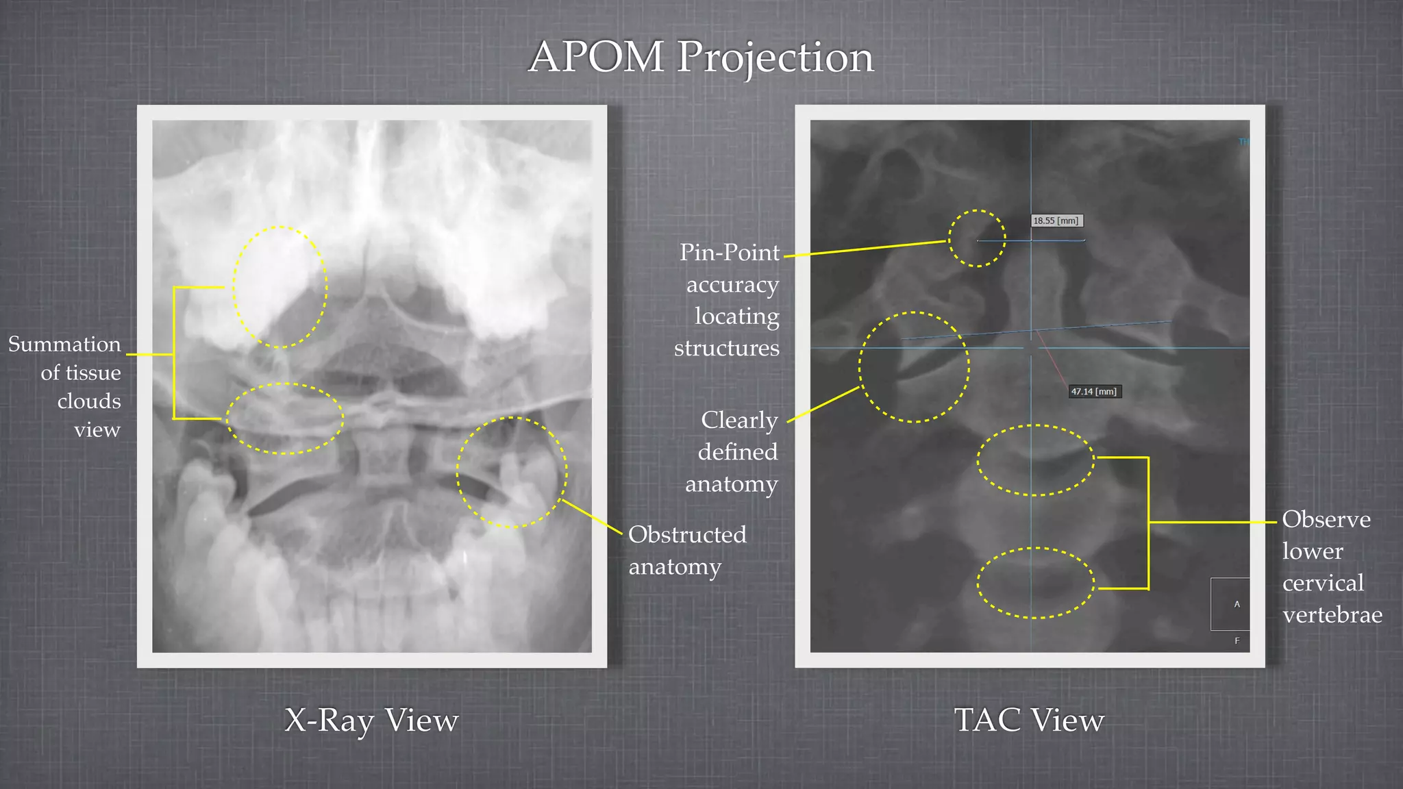 Upper Cervical Cone Beam 3D Preview | PDF
